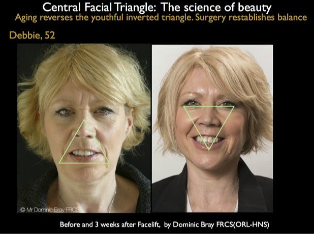 Science Of Beauty In The Facelift