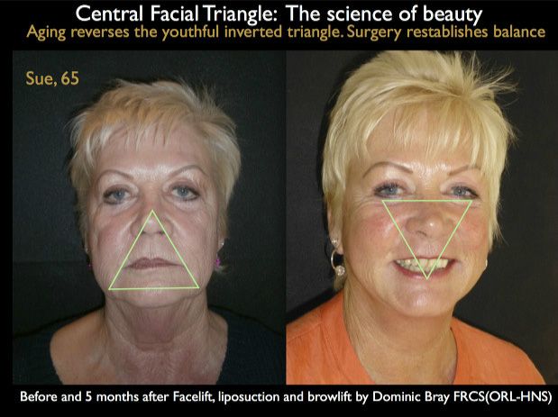 Science Of Beauty In The Facelift