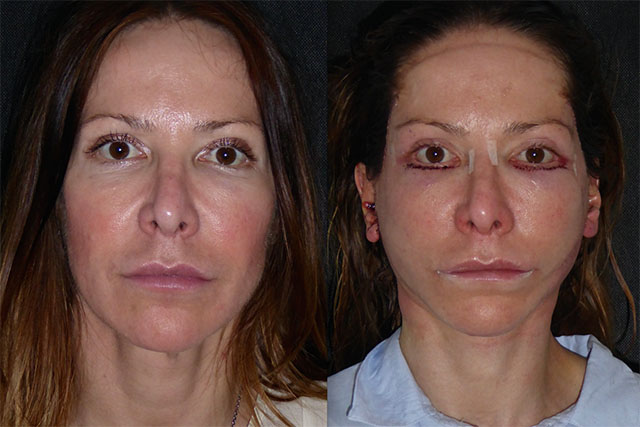 Davina; 47, Facelift, Neck lift, Lower eyelid, pinch surgery - Dominic Bray