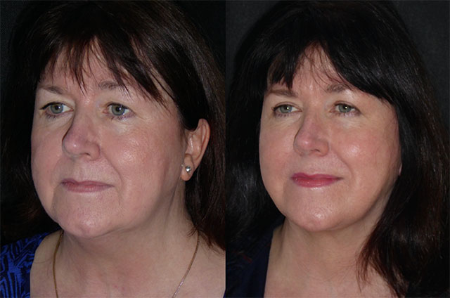 Julie Chin Before And After