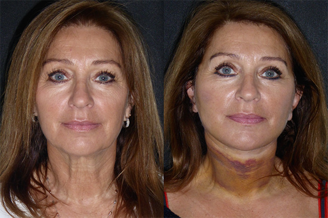 Linda; 59, Facelift, neck lift, platysmaplasty surgery - Dominic Bray