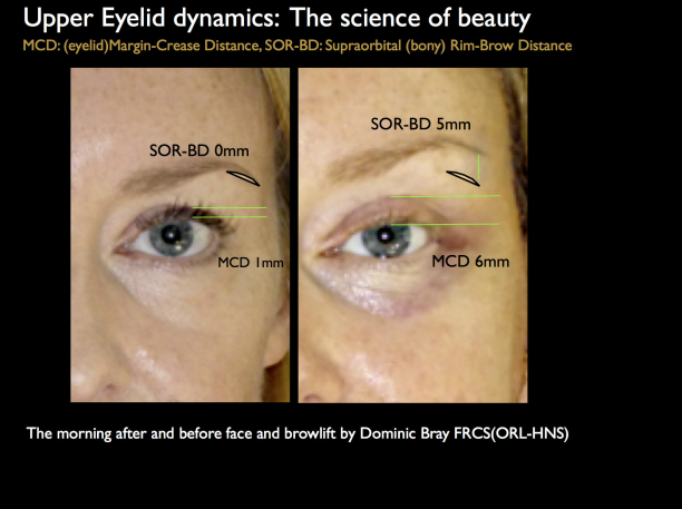 Science of beauty in the facelift