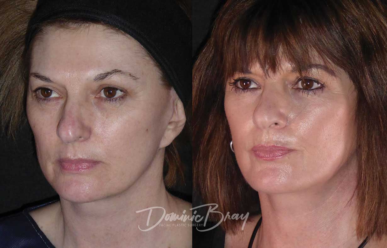 Debbie, 52 | Revision Facelift Before and After