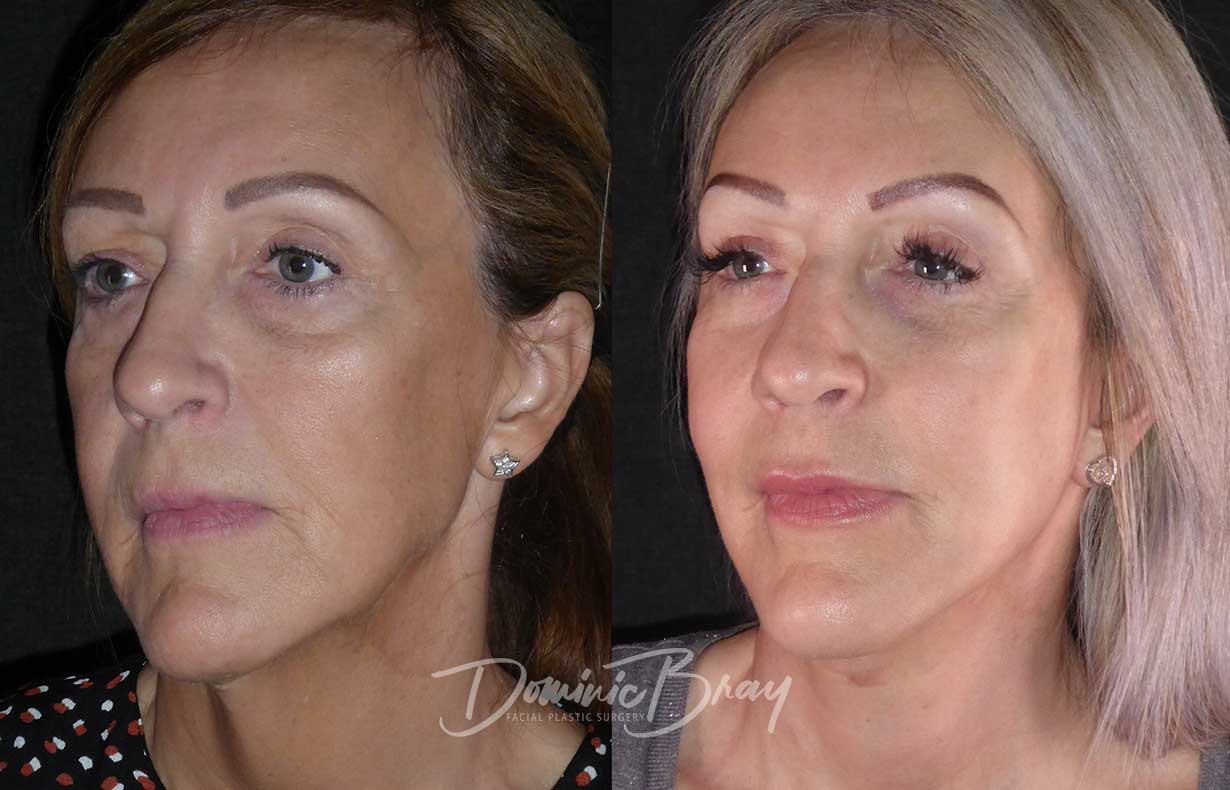 Jacqueline, 52 | 45-54, Brow, Eyelid Surgery, Eyes, Face & Necklift ...
