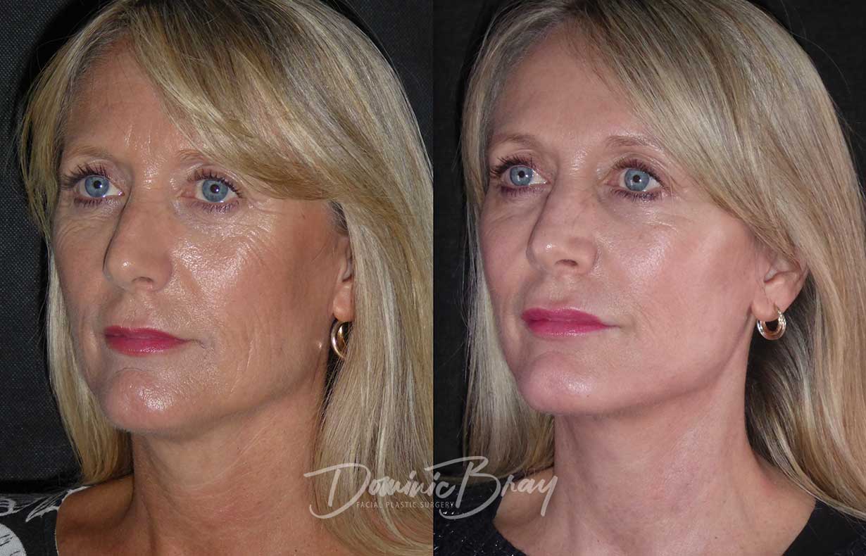 Jane, 50 | Facelift at 50: Before and After Pictures