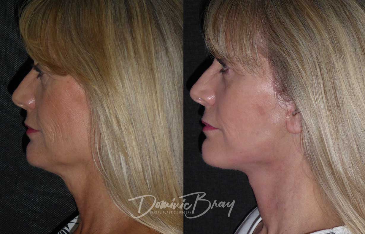 Jane, 50 | Facelift at 50: Before and After Pictures