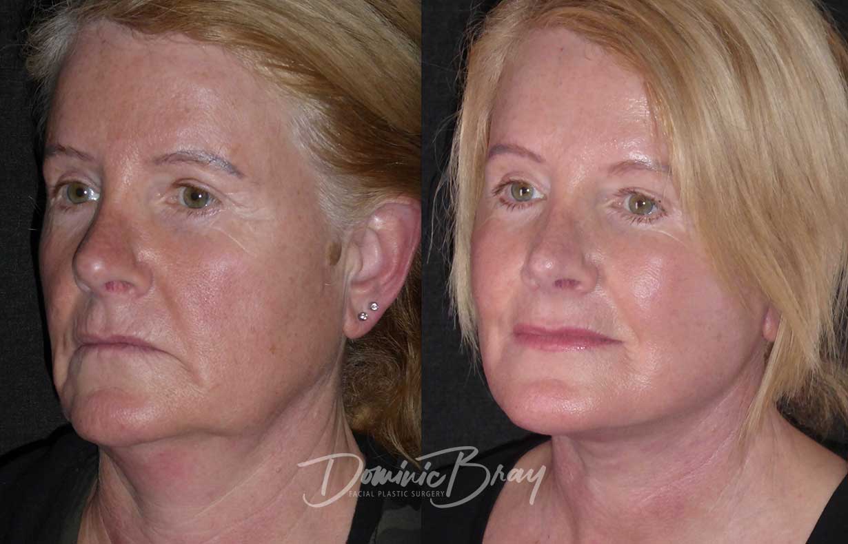 Helen, 59 | 55-64, Face & Necklift, Liposculpture, Neck