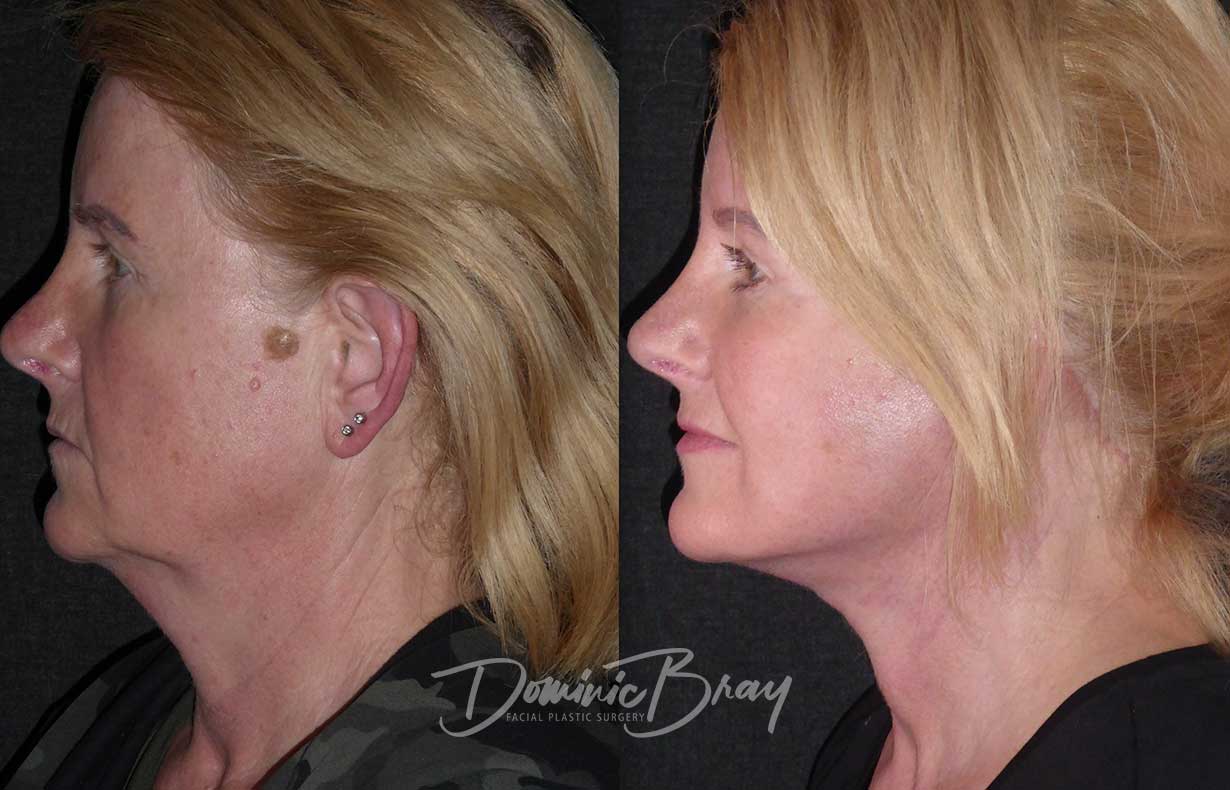Helen, 59 | 55-64, Face & Necklift, Liposculpture, Neck