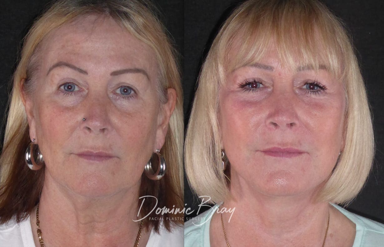 Neck plastic surgery London | Dr. Dominic Bray