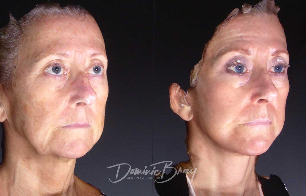 Fiona, 59 | 55-64, Brow, Eyelid Surgery, Eyes, Face & Necklift, Jowls, Neck