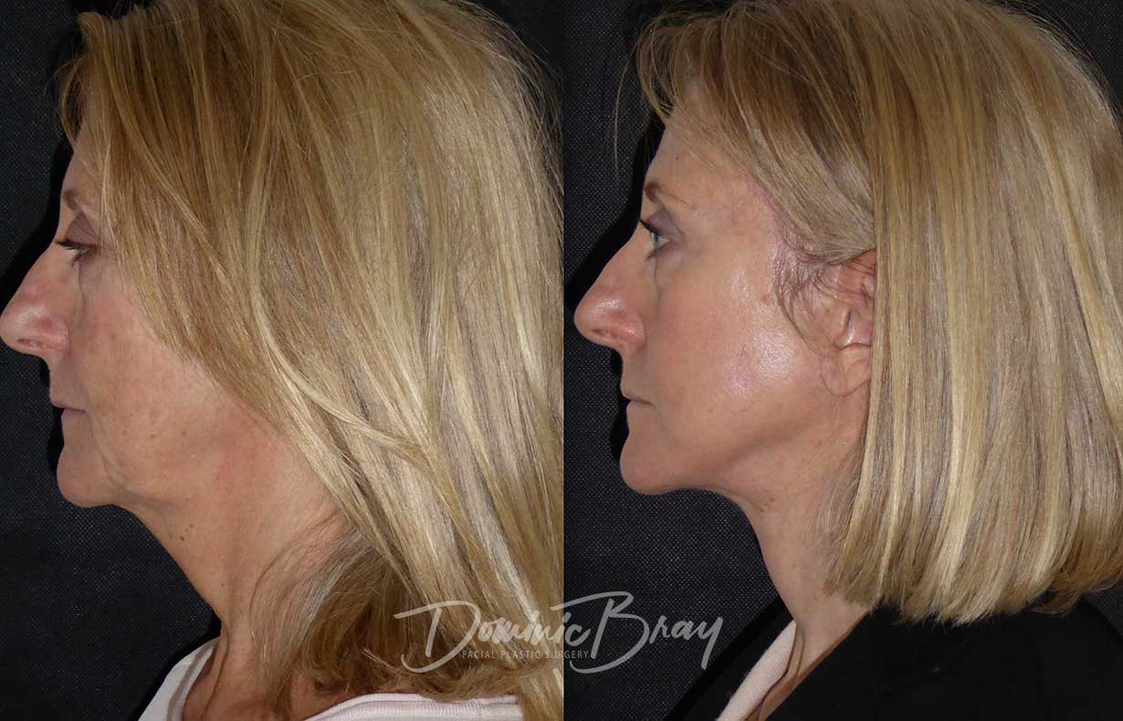 Fiona, 59 | 55-64, Brow, Eyelid Surgery, Eyes, Face & Necklift, Jowls, Neck
