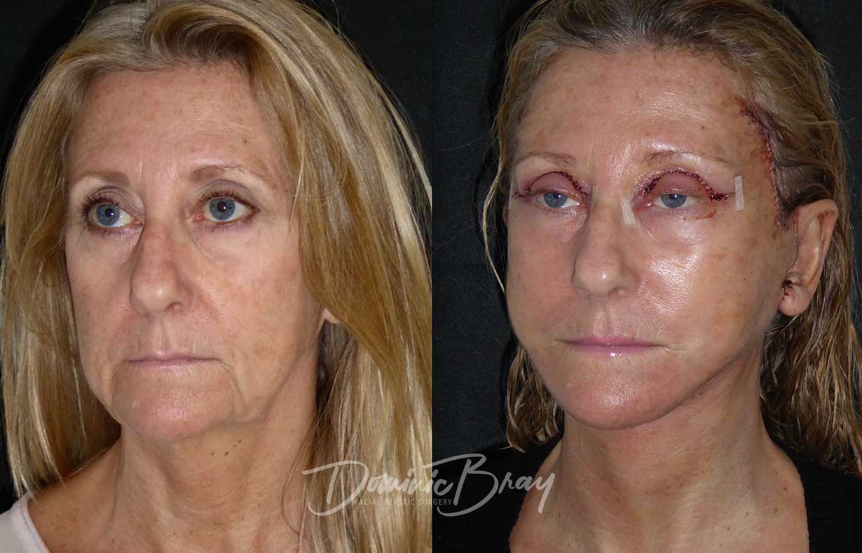 Fiona, 59 | 55-64, Brow, Eyelid Surgery, Eyes, Face & Necklift, Jowls, Neck