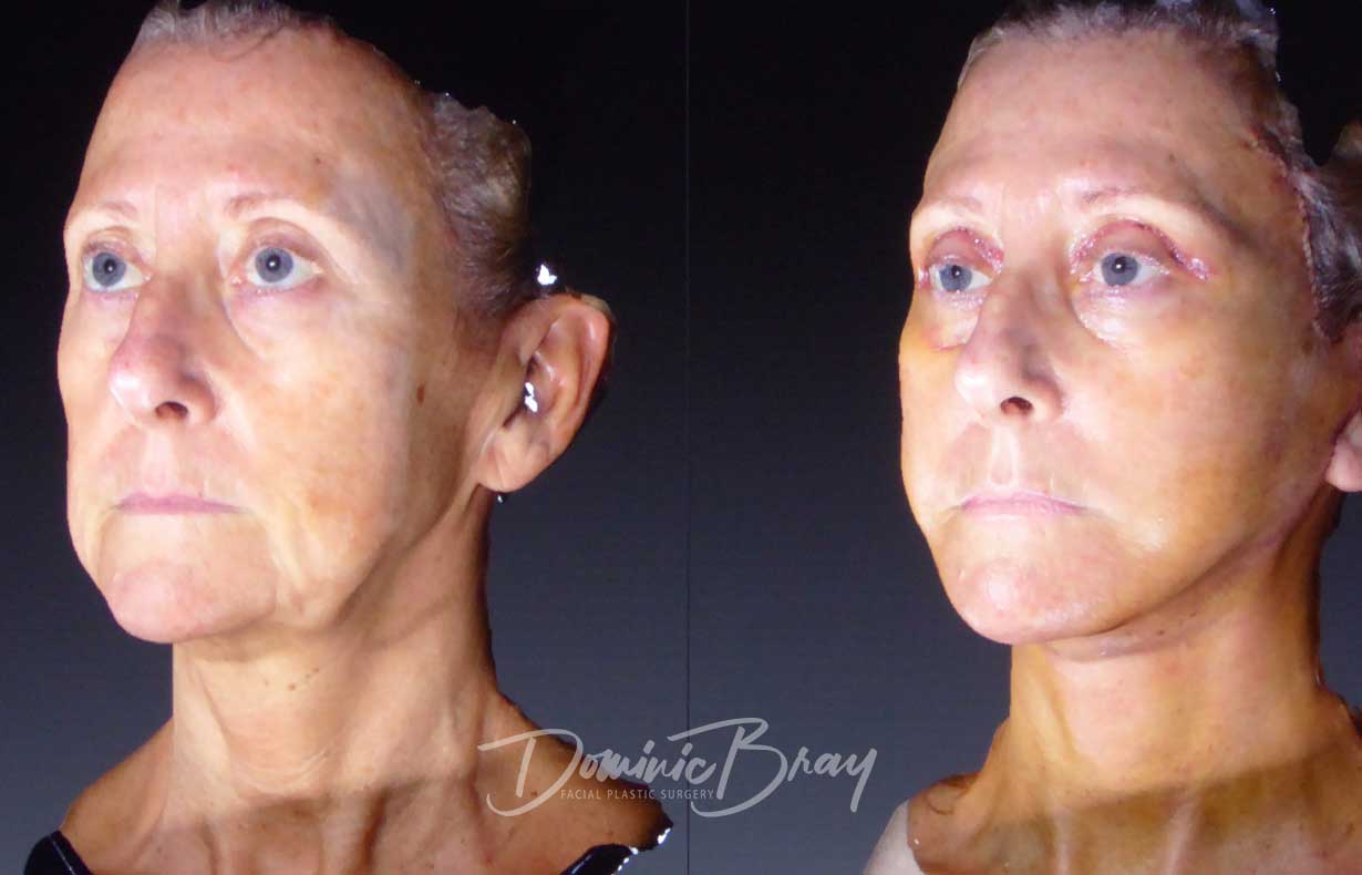 Fiona, 59 | 55-64, Brow, Eyelid Surgery, Eyes, Face & Necklift, Jowls, Neck