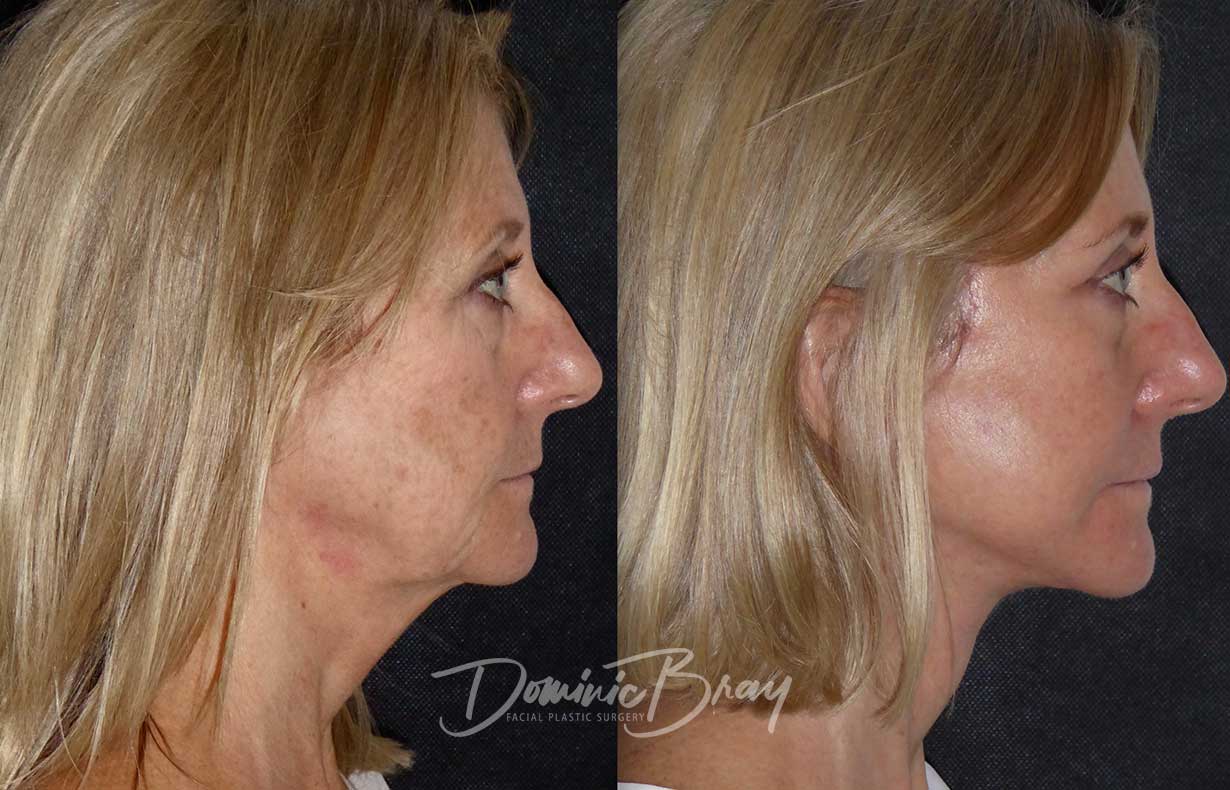 Fiona, 59 | 55-64, Brow, Eyelid Surgery, Eyes, Face & Necklift, Jowls, Neck