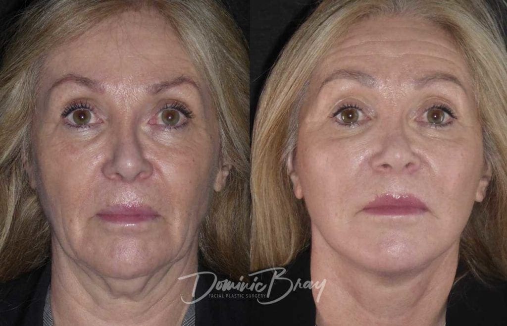 How to Get Rid of Forehead lines | Dr. Dominic Bray | Facelift Plastic ...