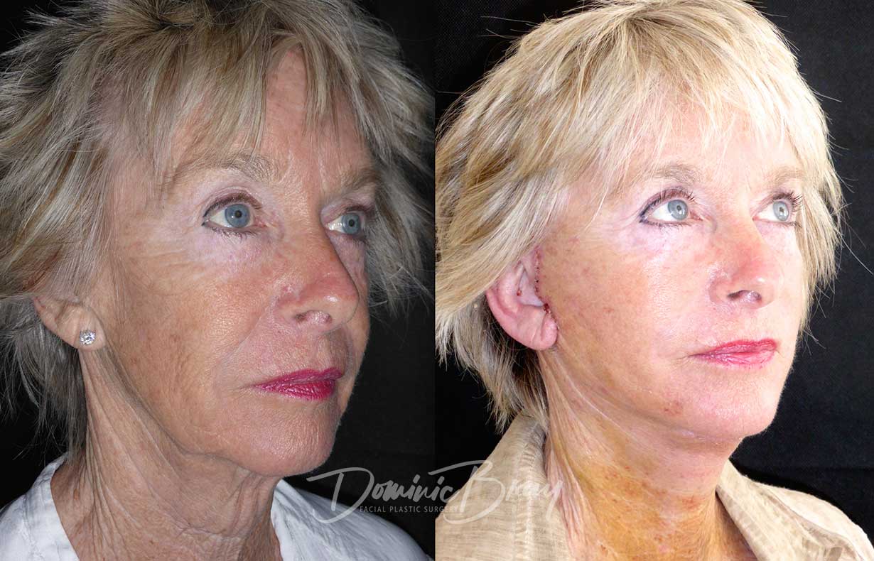 Maxine, 72 | 65+, Face & Necklift, Jowls, Neck, Revision Facelift | Dr ...