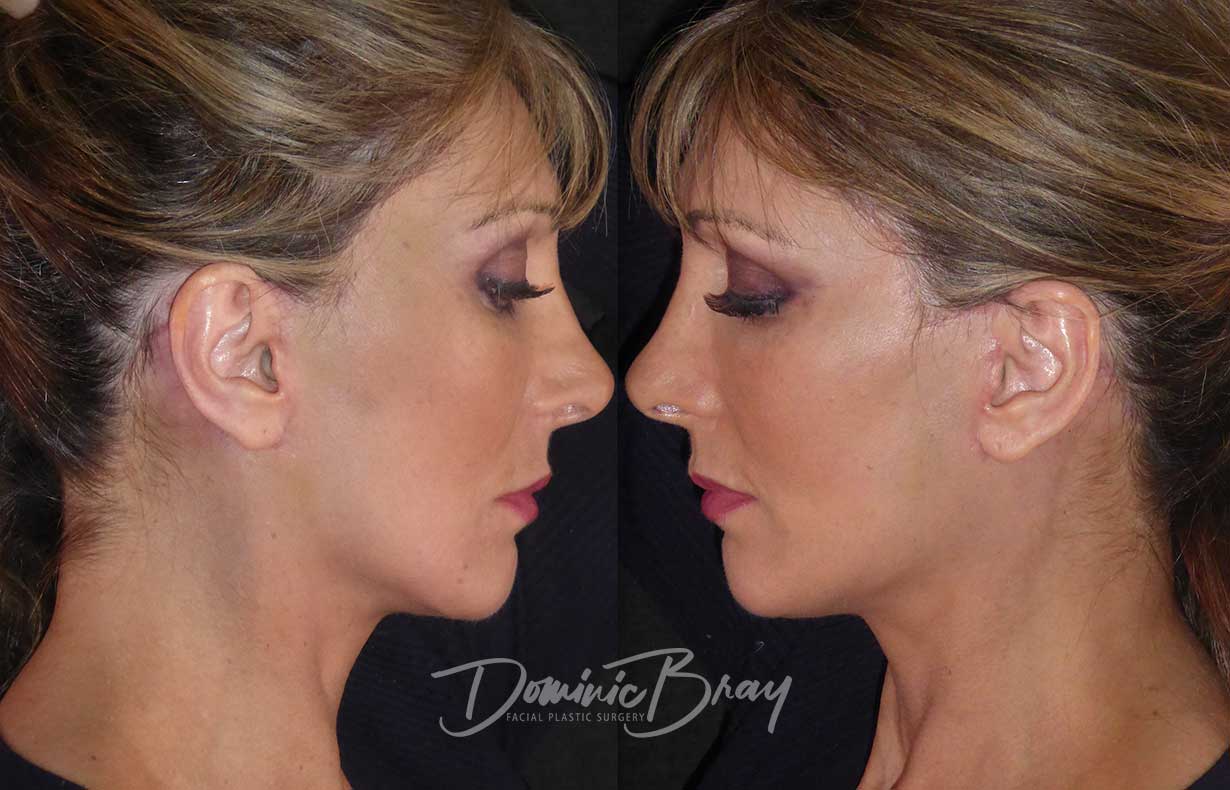 How To Get Rid Of A Turkey Neck With Surgery | Dr. Dominic Bray ...