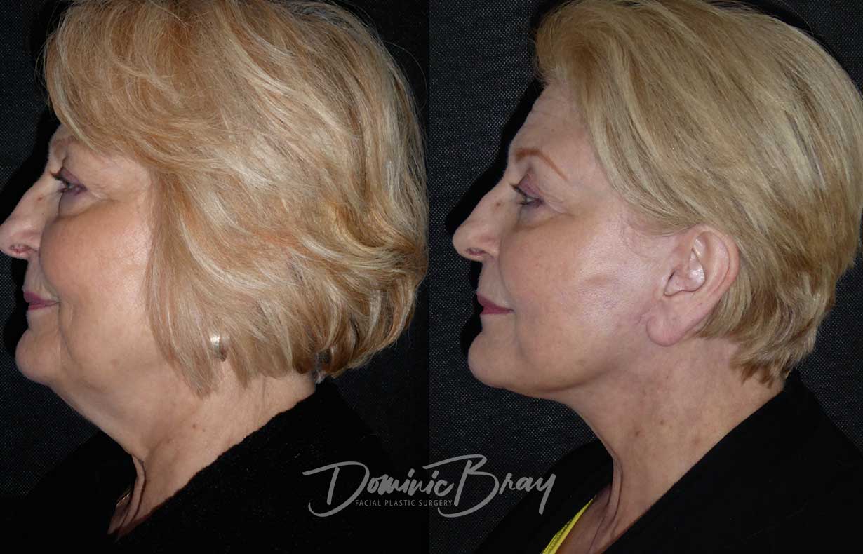 Zoe, 69 | 65+, Brow, Eyelid Surgery, Eyes, Face & Necklift, Jowls ...