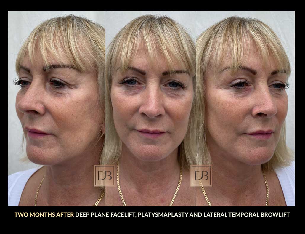 Stages Of Facelift Recovery Dr Dominic Bray